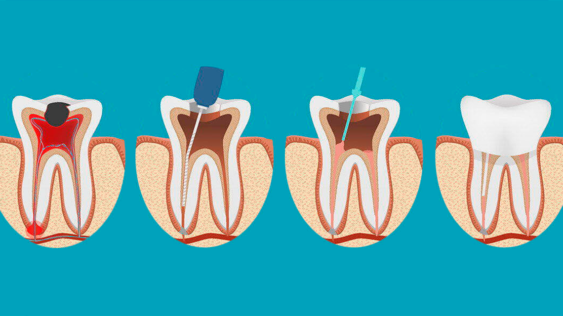 Paso a Paso de una Endodoncia o Root Canal • Dr. Julian Lopera Ramirez